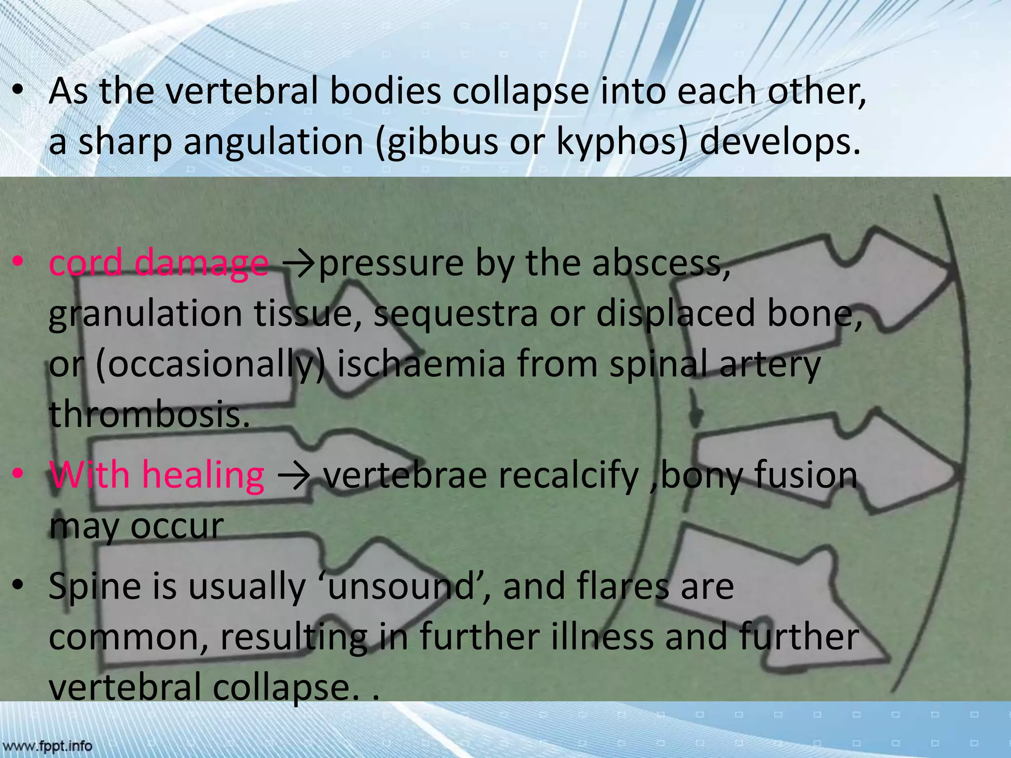 Pott's disease- tuberculosis of the spine | PPTX