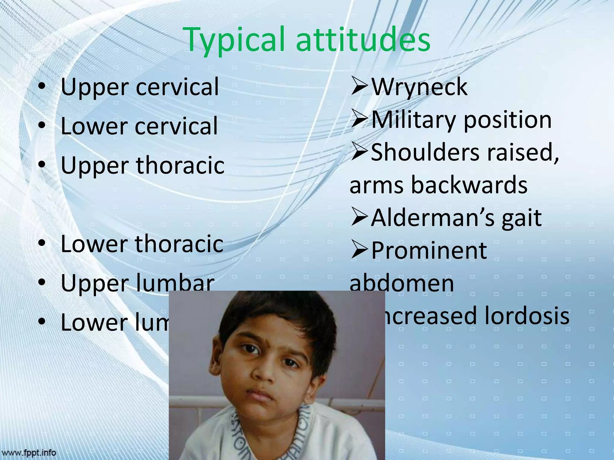 Pott's disease- tuberculosis of the spine | PPTX