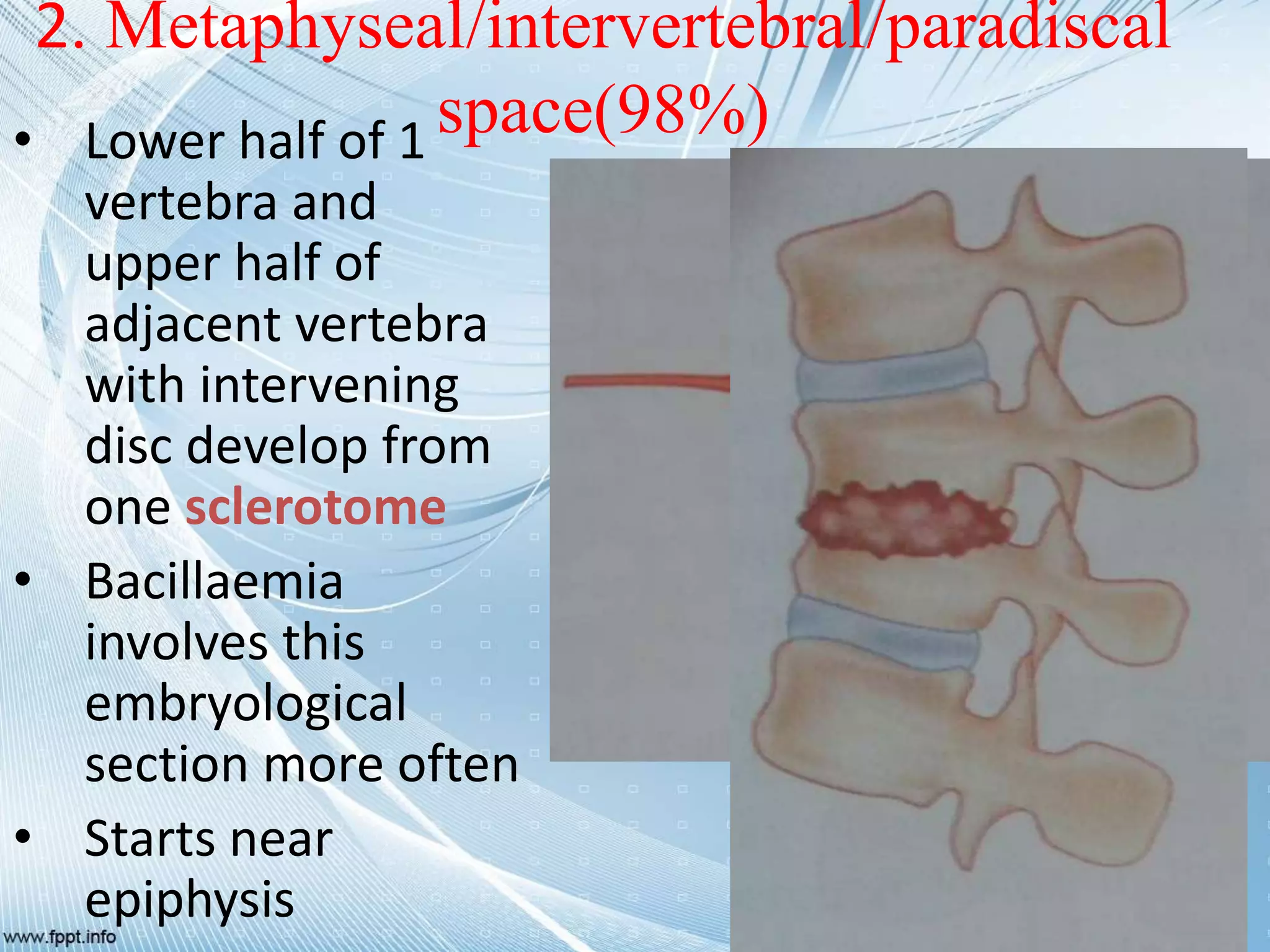 Pott's disease- tuberculosis of the spine | PPTX