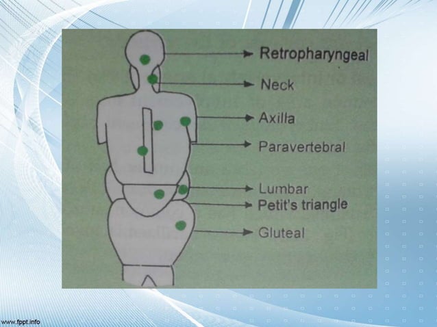 Pott's disease- tuberculosis of the spine | PPTX