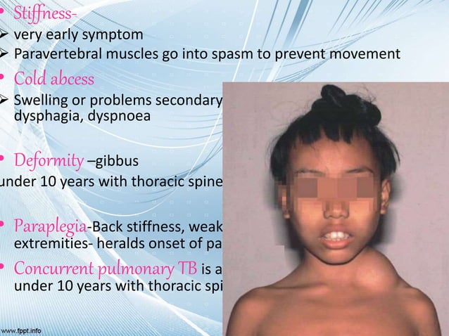 Pott's disease- tuberculosis of the spine | PPTX