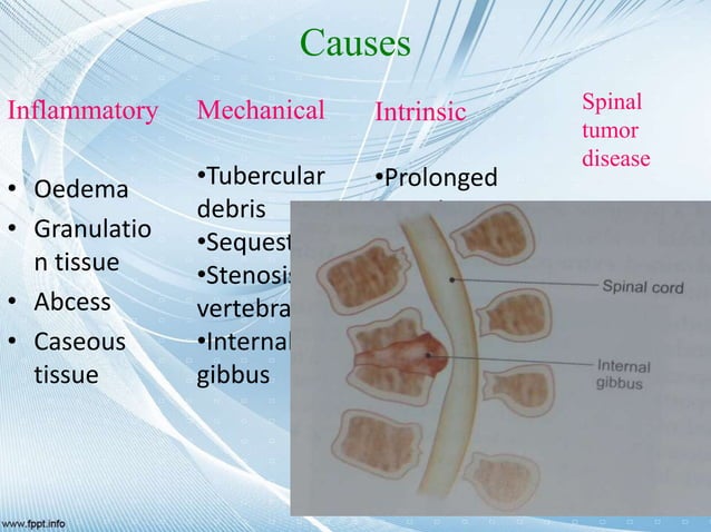 Pott's disease- tuberculosis of the spine | PPTX