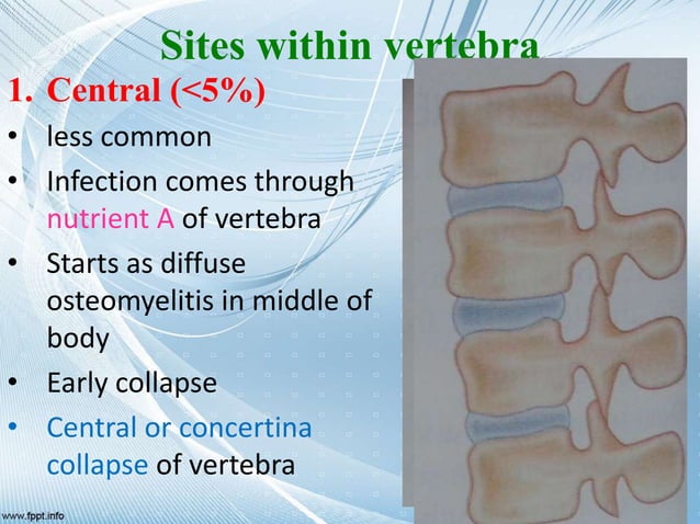 Pott's disease- tuberculosis of the spine | PPTX