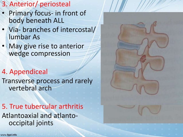 Pott's disease- tuberculosis of the spine | PPTX