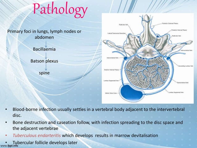 Pott's disease- tuberculosis of the spine | PPT
