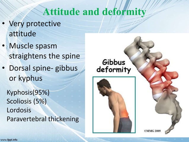 Pott's disease- tuberculosis of the spine | PPT