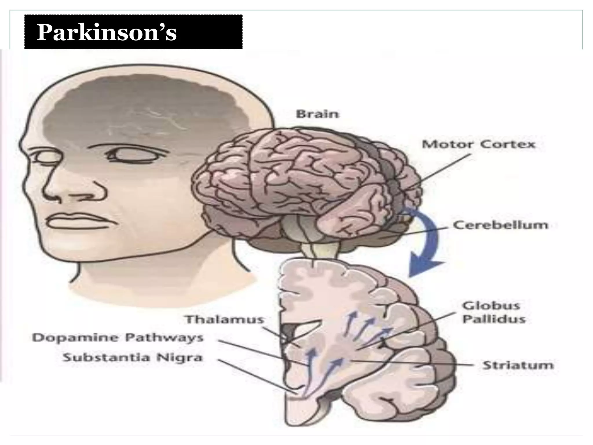 Pathophysiology of Parkinsons Disease | PPTX