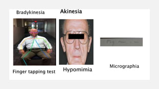 Physiotherapy Assessment and management of Parkinson's disease | PPTX