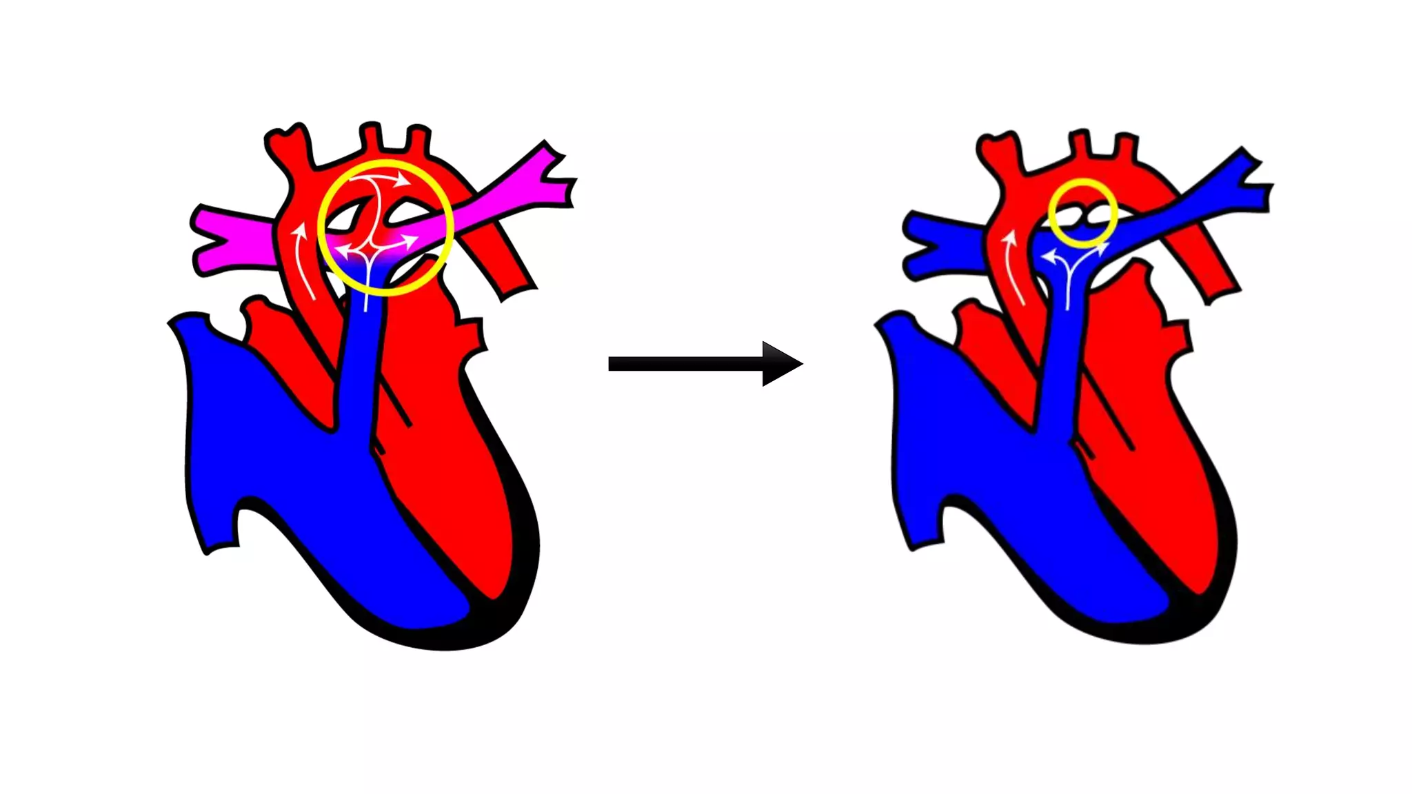 Patent Ductus Arteriosus - management in preterm infants | PPTX