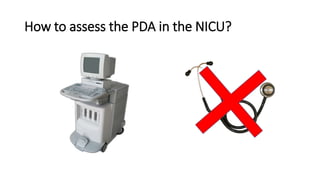 Patent Ductus Arteriosus - management in preterm infants | PPTX