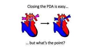 Patent Ductus Arteriosus - management in preterm infants | PPTX