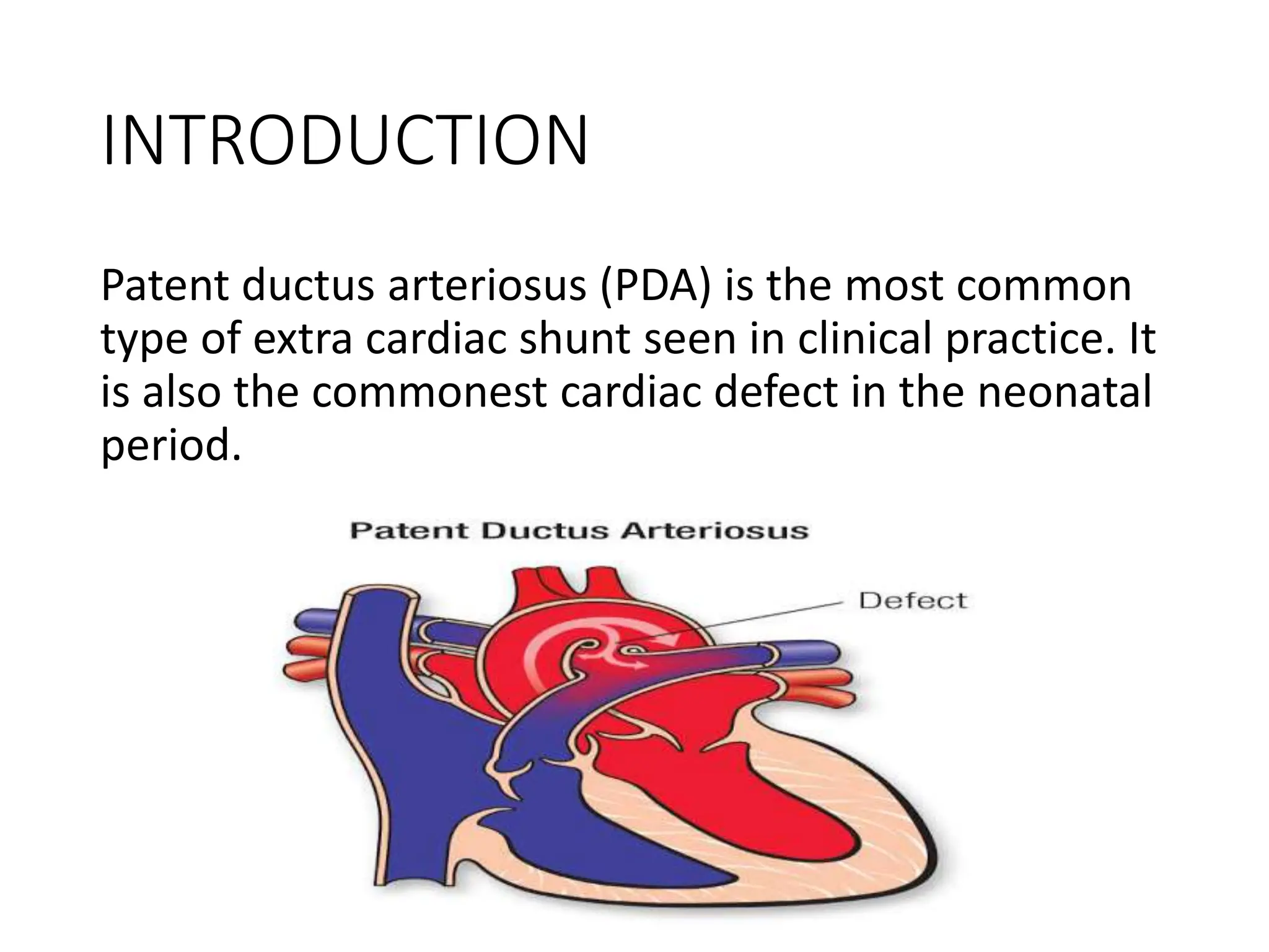 Patent ductus arteriosus(pda) paediatrics.pptx