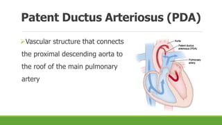 Imaging Findings of Patent Ductus Arteriosus.pptx