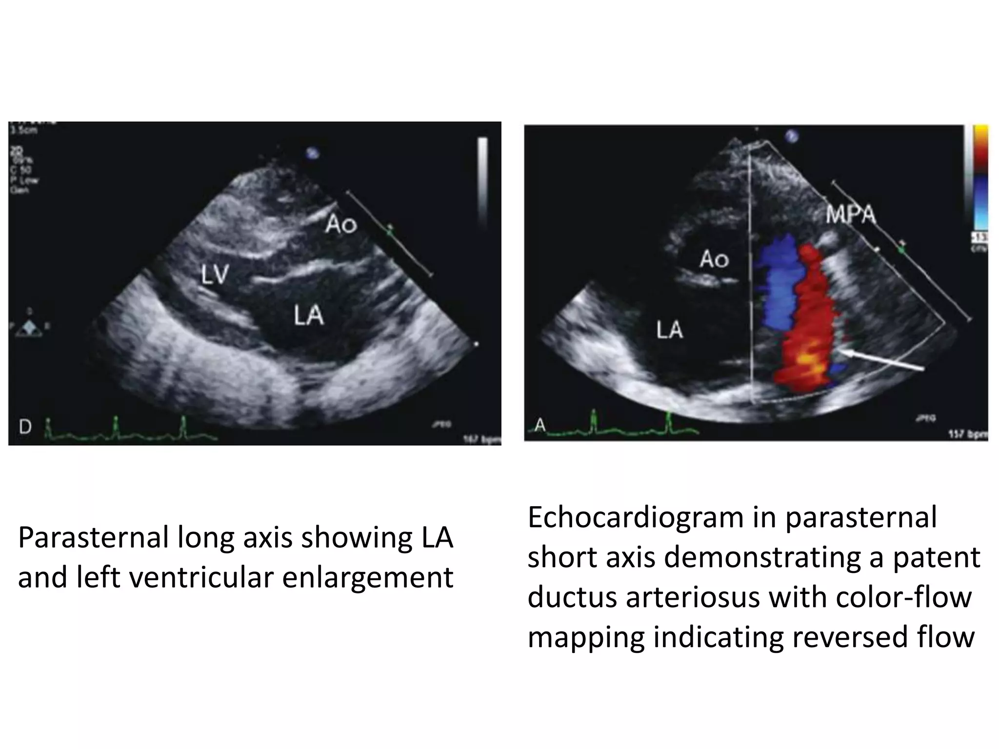 Patent Ductus Arteriosus (PDA) | PPTX