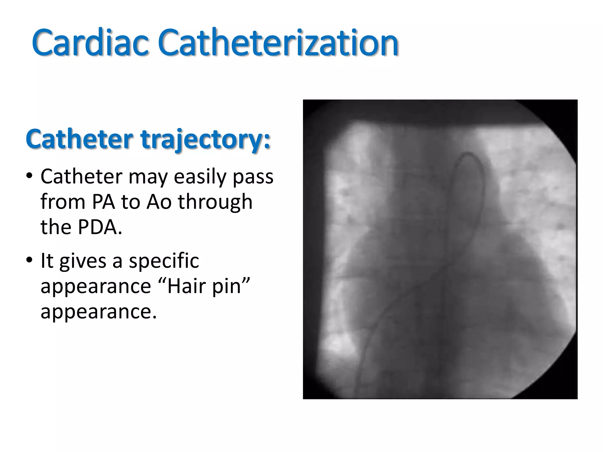 Patent Ductus Arteriosus (PDA) | PPTX