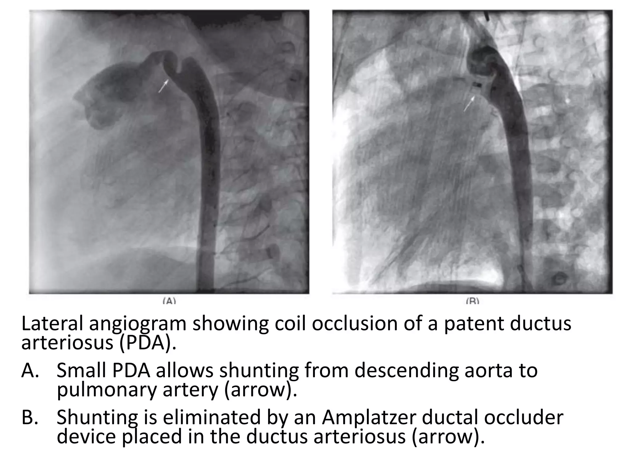 Patent Ductus Arteriosus (PDA) | PPTX