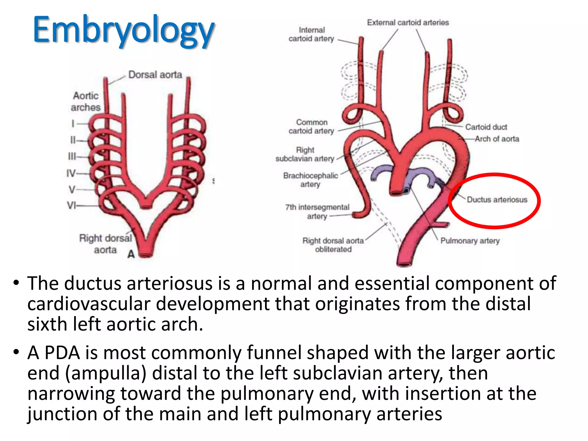 Patent Ductus Arteriosus (PDA) | PPTX