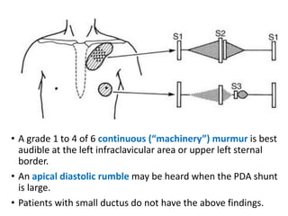 Patent Ductus Arteriosus (PDA) | PPTX