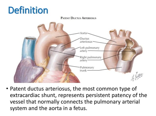 Patent Ductus Arteriosus (PDA) | PPTX