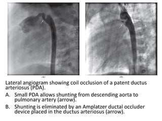Patent Ductus Arteriosus (PDA) | PPTX