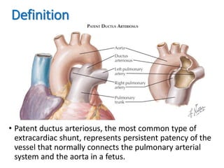 Patent Ductus Arteriosus Ligation
