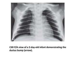Patent Ductus Arteriosus X Ray