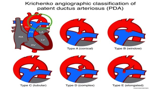PDA,AP WINDOW, TA.pptx | Pregnancy | Reproductive Health