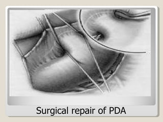 Pda Part 6 Treatment | PPT