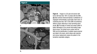 Đánh giá khối u tuỵ trên CLVT | PDF