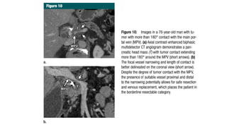Đánh giá khối u tuỵ trên CLVT | PDF