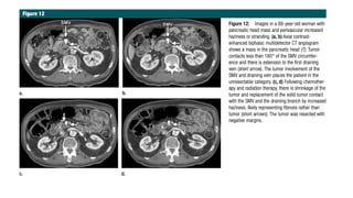 Đánh giá khối u tuỵ trên CLVT | PDF