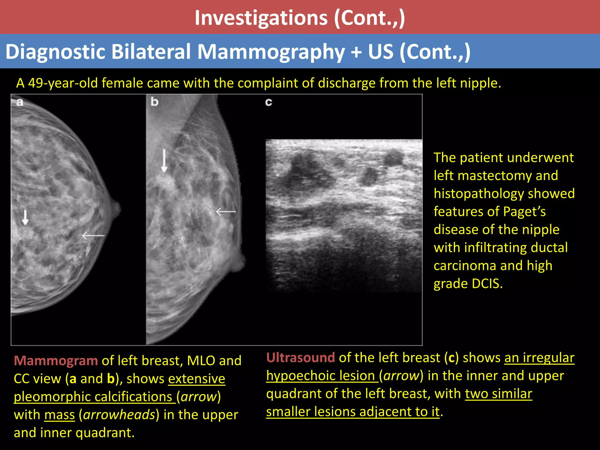 Paget’s Disease of Breast (PDB) | PPTX