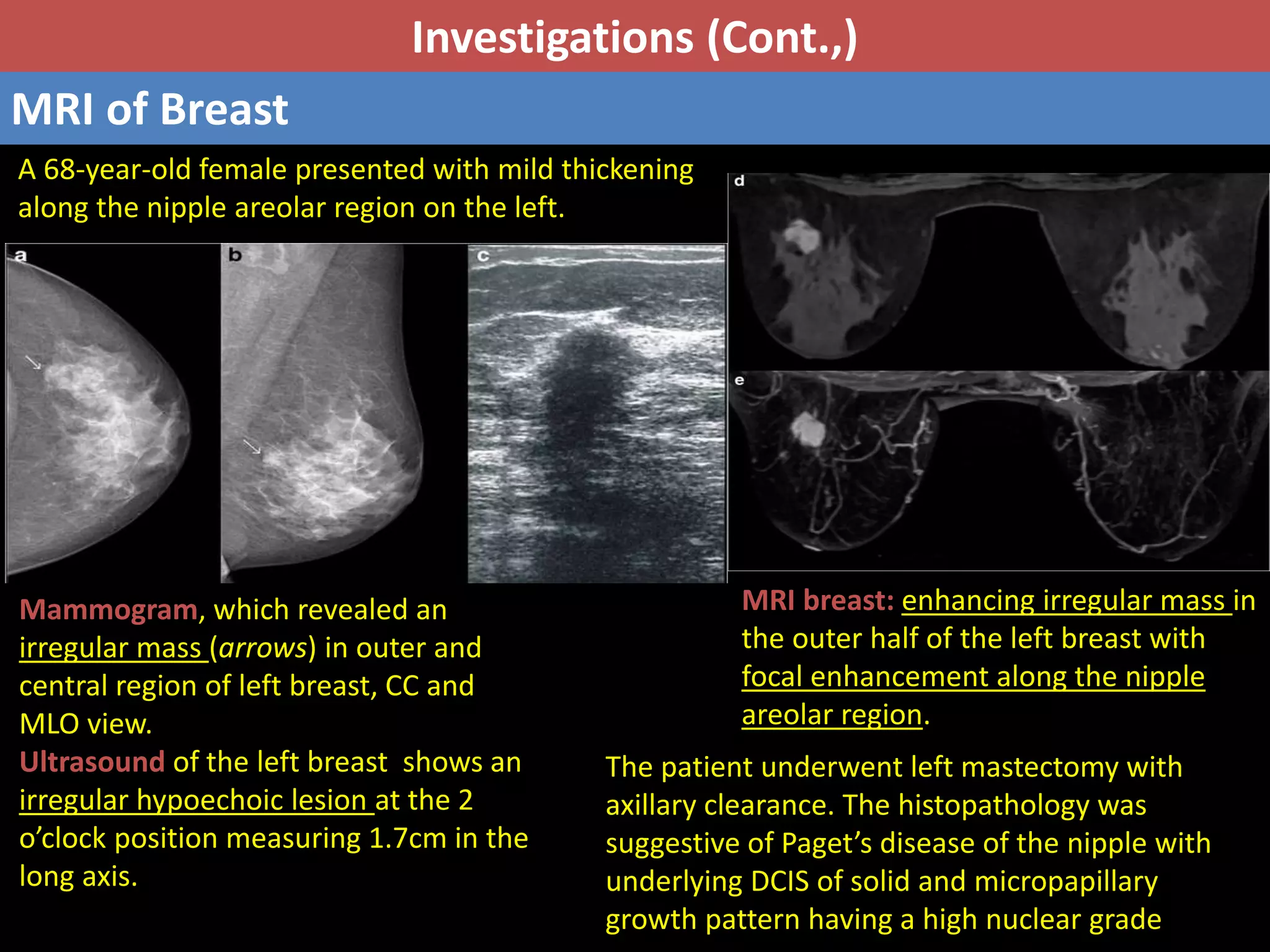 Paget’s Disease of Breast (PDB) | PPTX