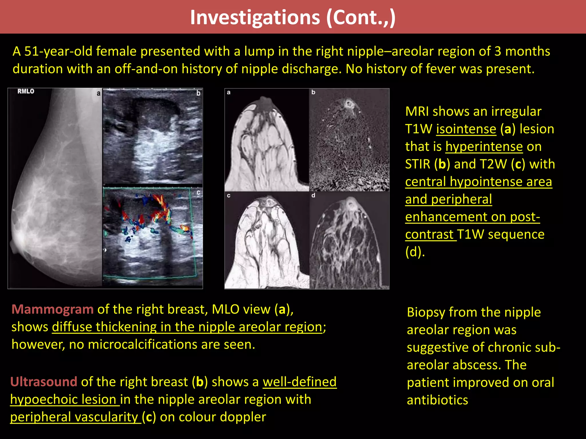 Paget’s Disease of Breast (PDB) | PPTX