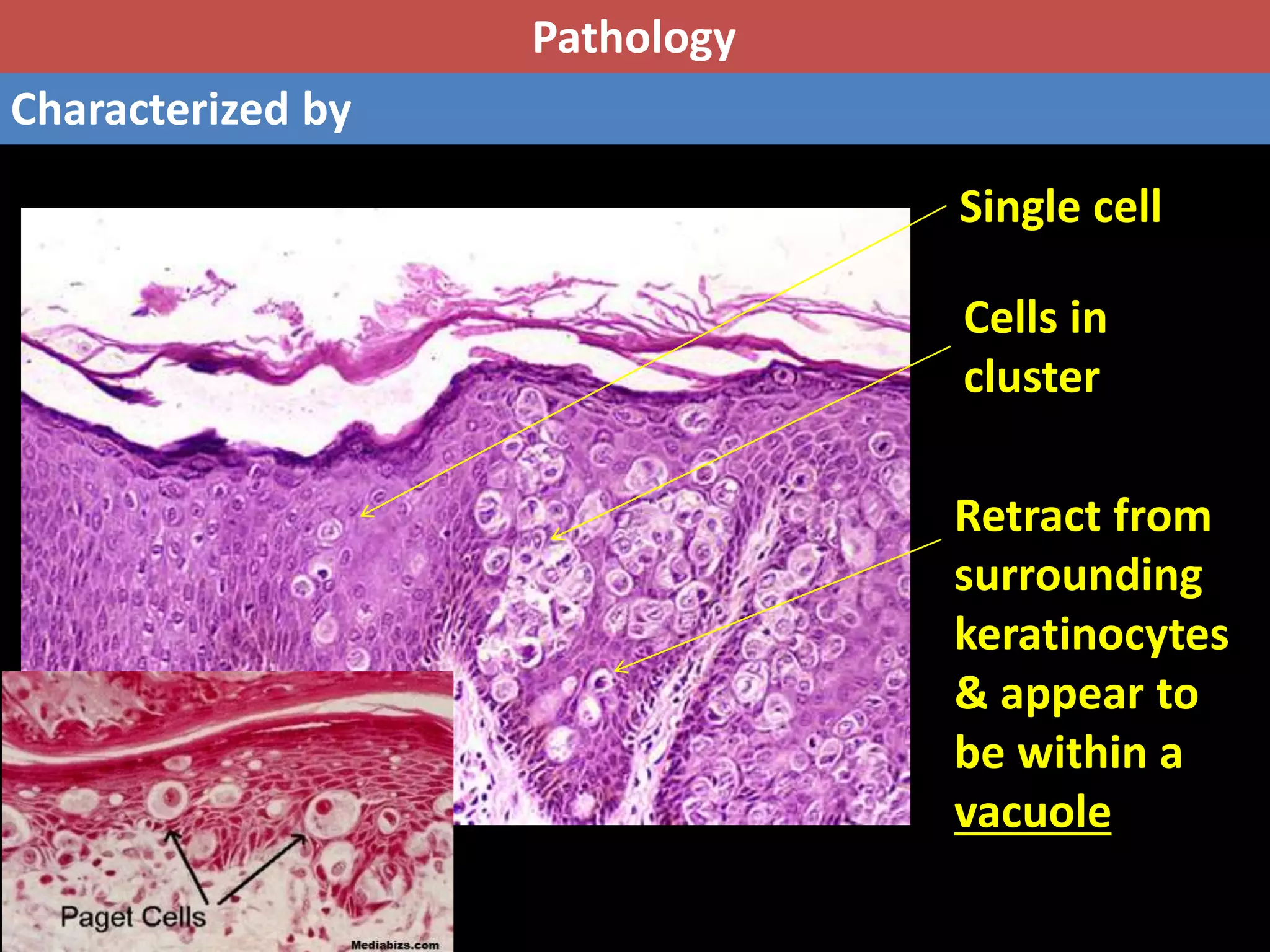 Paget’s Disease of Breast (PDB) | PPTX