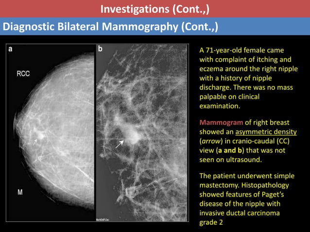 Paget’s Disease of Breast (PDB) | PPTX