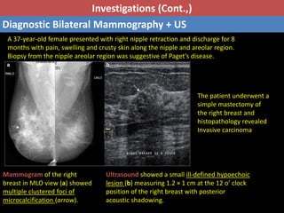 Paget’s Disease of Breast (PDB) | PPTX