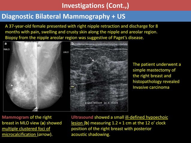 Paget’s Disease of Breast (PDB) | PPTX