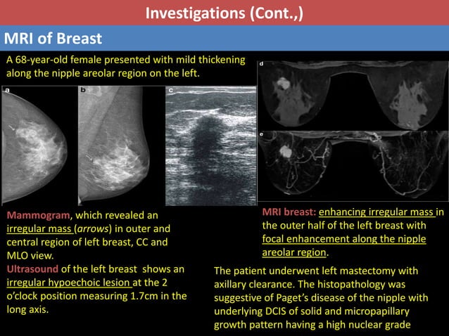 Paget’s Disease of Breast (PDB) | PPTX