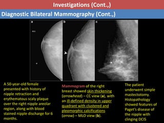 Paget S Disease Of Breast Pdb Pptx