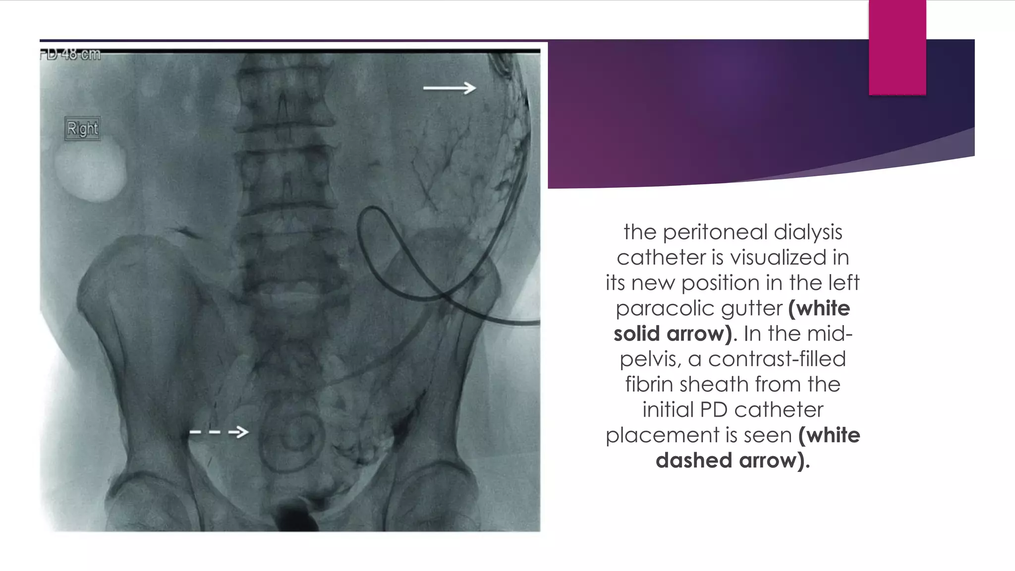 Peritoneal dialysis catheter dysfunction | PDF