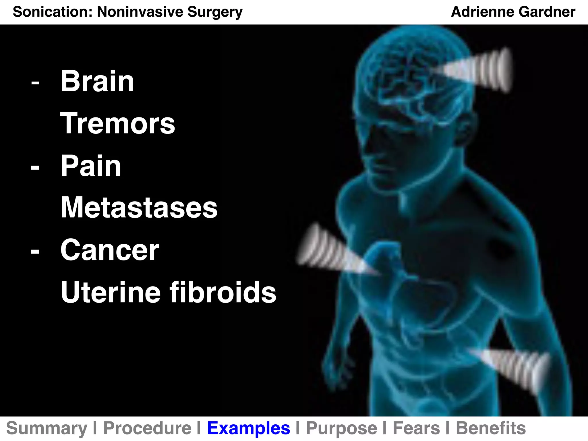 Sonication: Noninvasive Surgery | PDF | Surgery | Medical Health