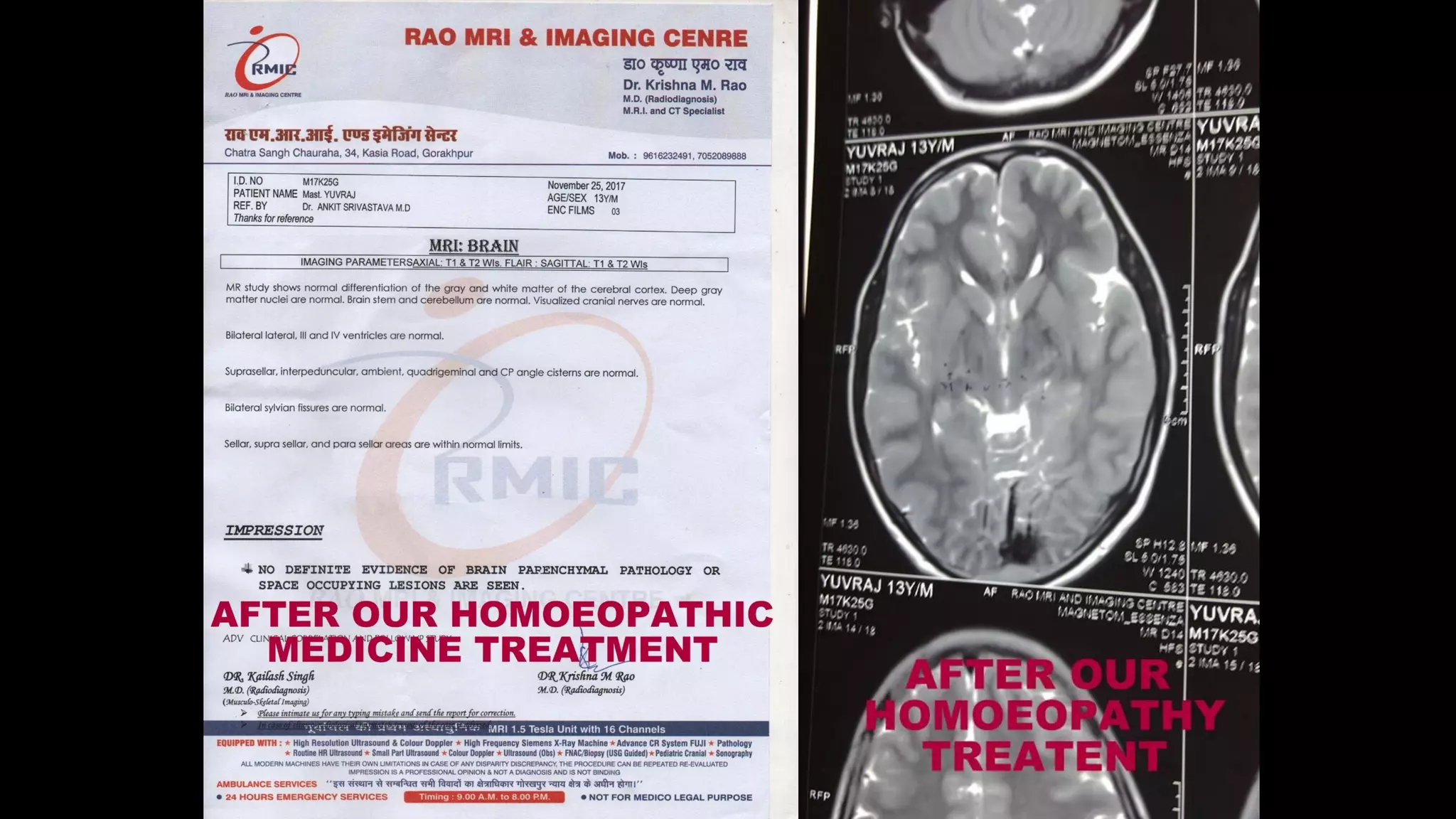 Case of Cerebral Atrophy, Ventricular Dilatation, Atrophy of Splenium ...