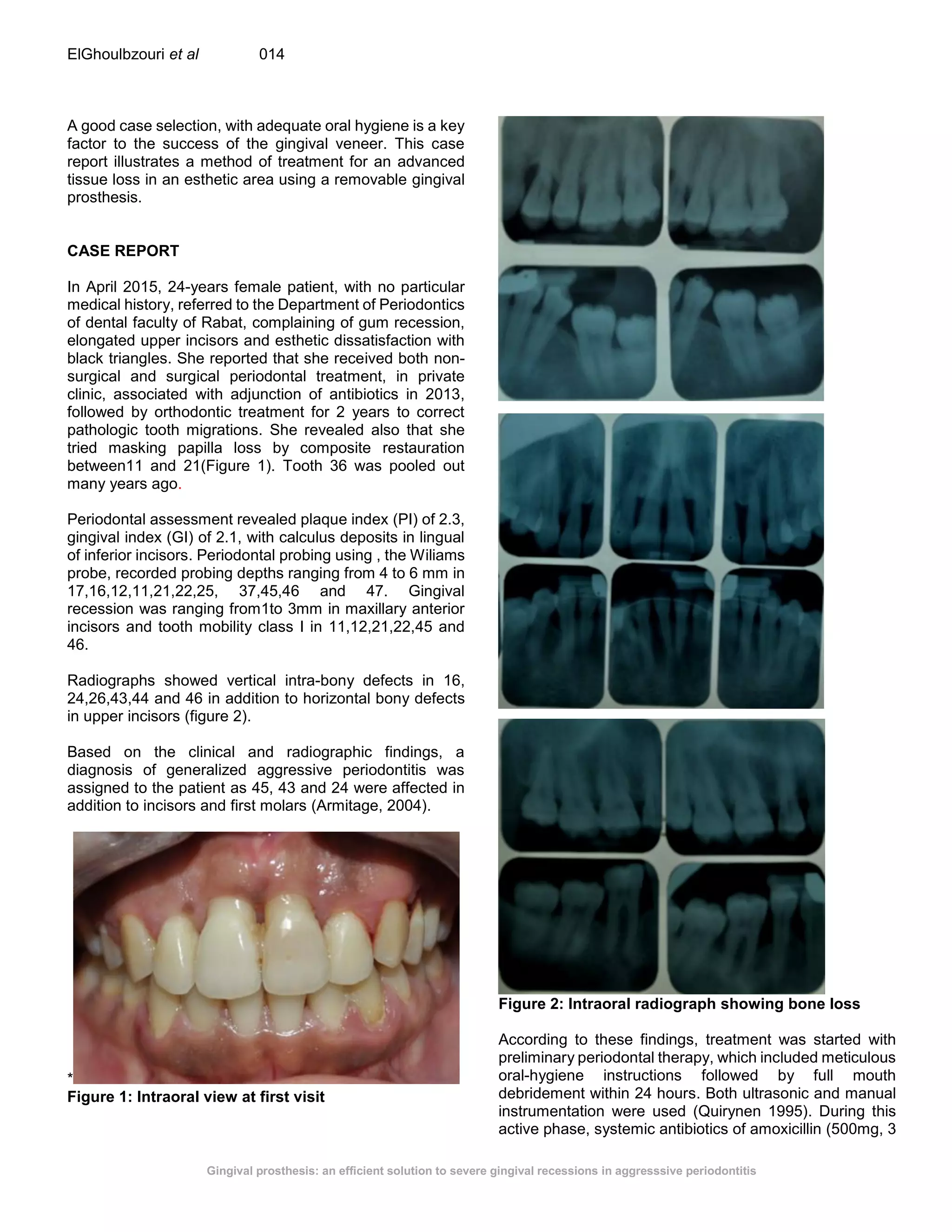 Gingival prosthesis: an efficient solution to severe gingival ...