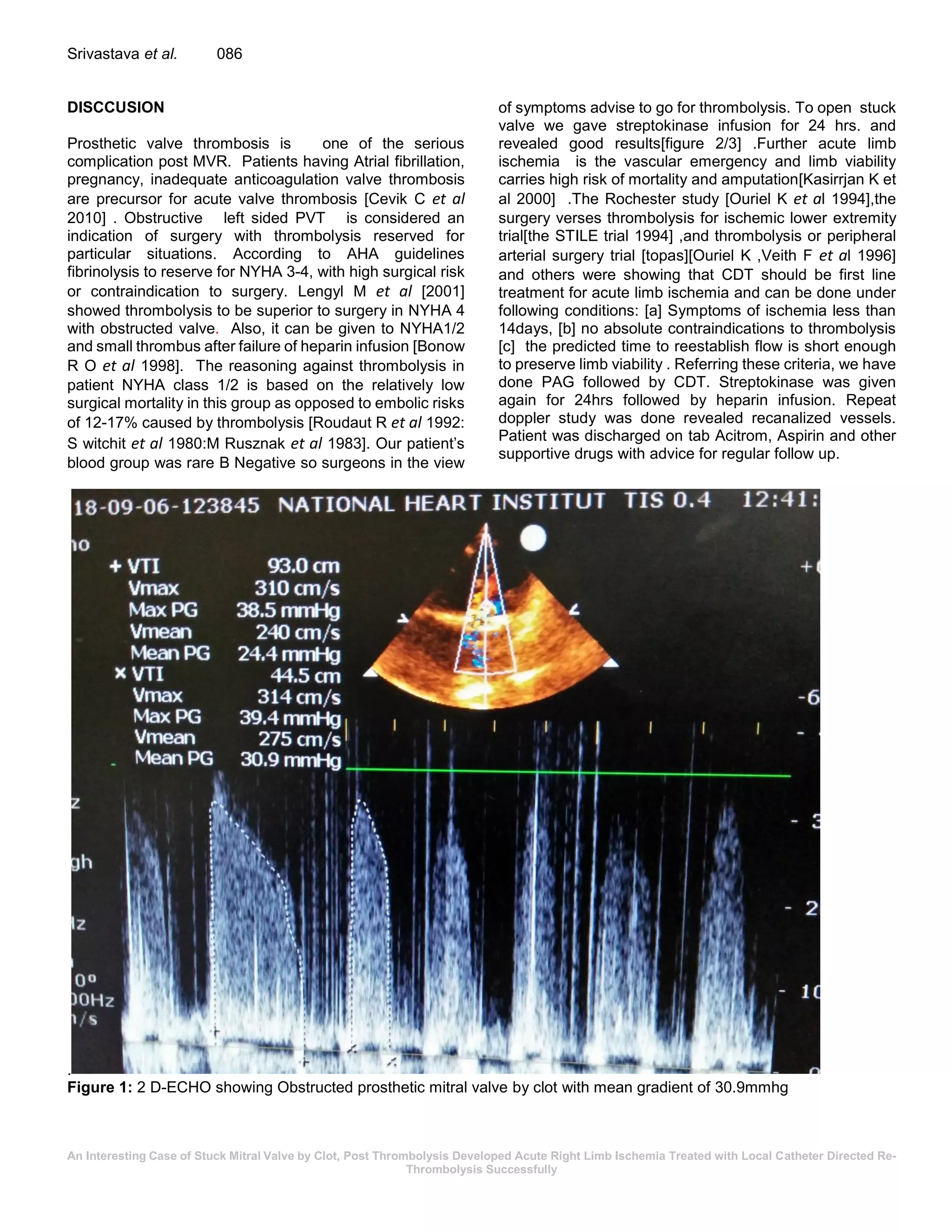 An Interesting Case of Stuck Mitral Valve by Clot, Post Thrombolysis ...