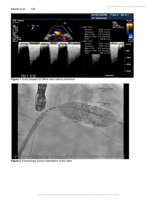Successful Valve in Ring Abolishing the Stenosis and Regurgitation with ...