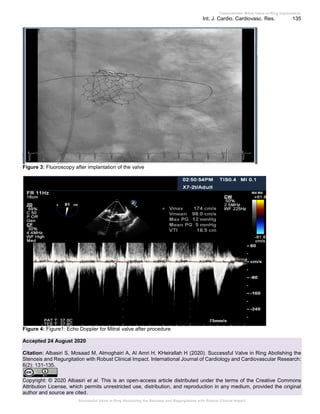 Successful Valve in Ring Abolishing the Stenosis and Regurgitation with ...
