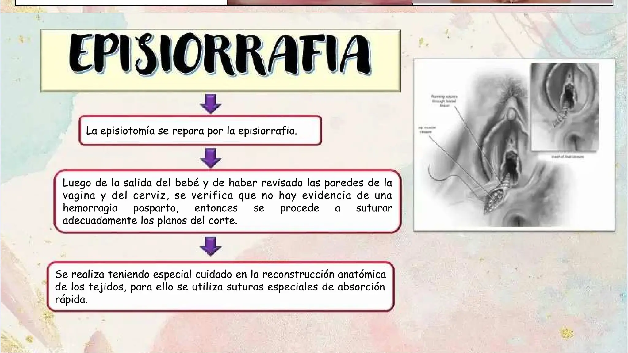pdf-episiotomia-y-episiorrafia_compress.pdf