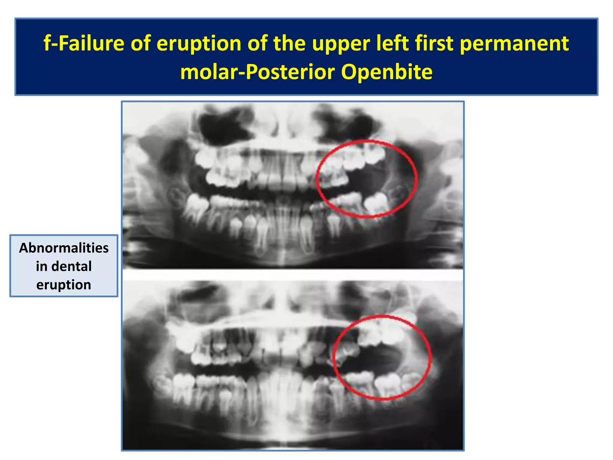 Pdf- open-bite-malocclusion | PDF
