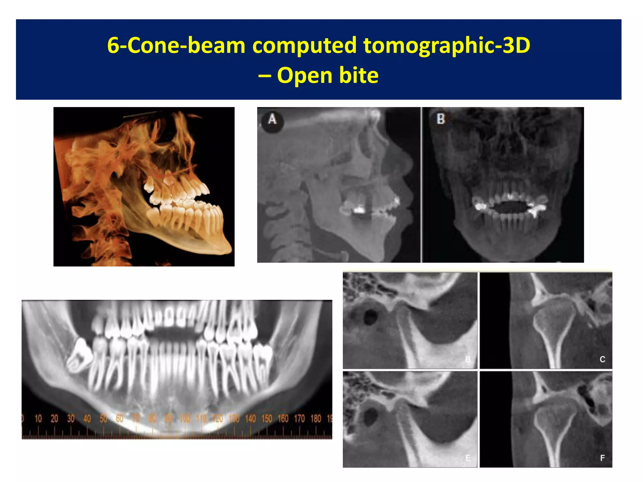 Pdf- open-bite-malocclusion | PDF